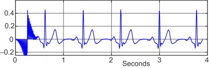 60-Hz Noise and Baseline Drift Reduction in ECG Signal Processing ...
